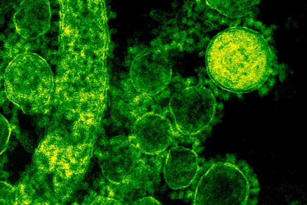 Explican qué es el hongo negro o mucormicosis y cómo se transmite - xeu ...